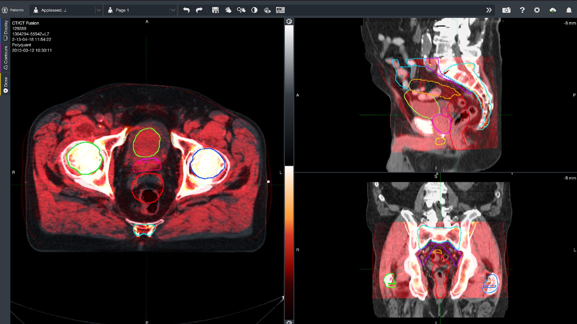Elekta ONE Planning | Oncology Software | Elekta