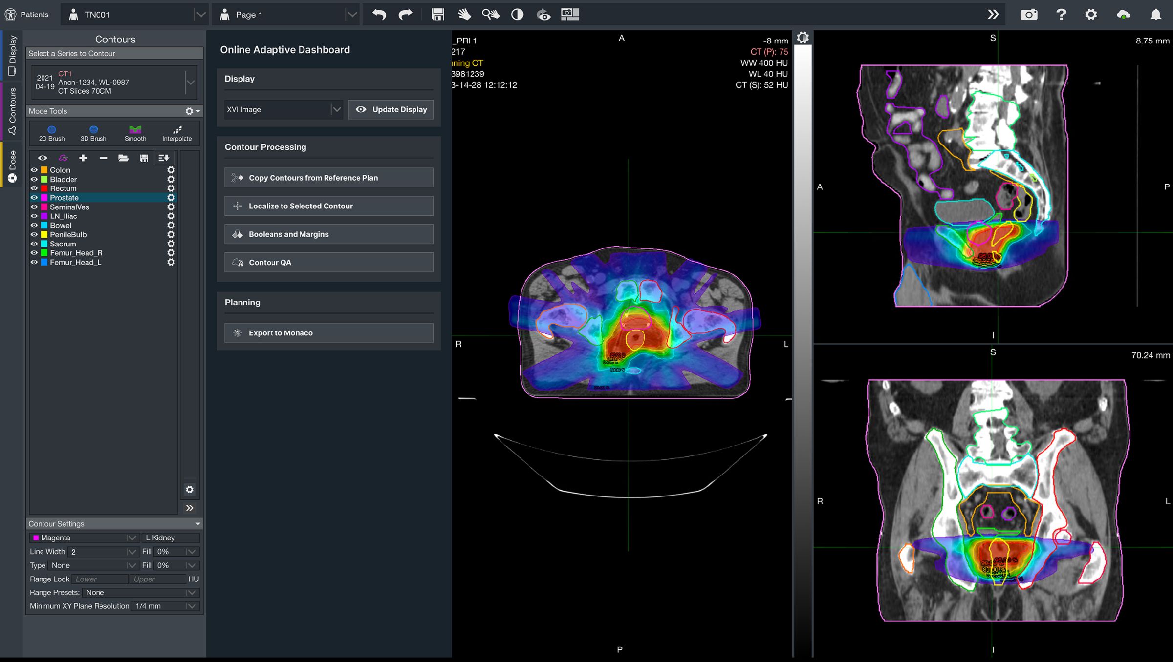 Elekta ONE Planning | Oncology Software | Elekta